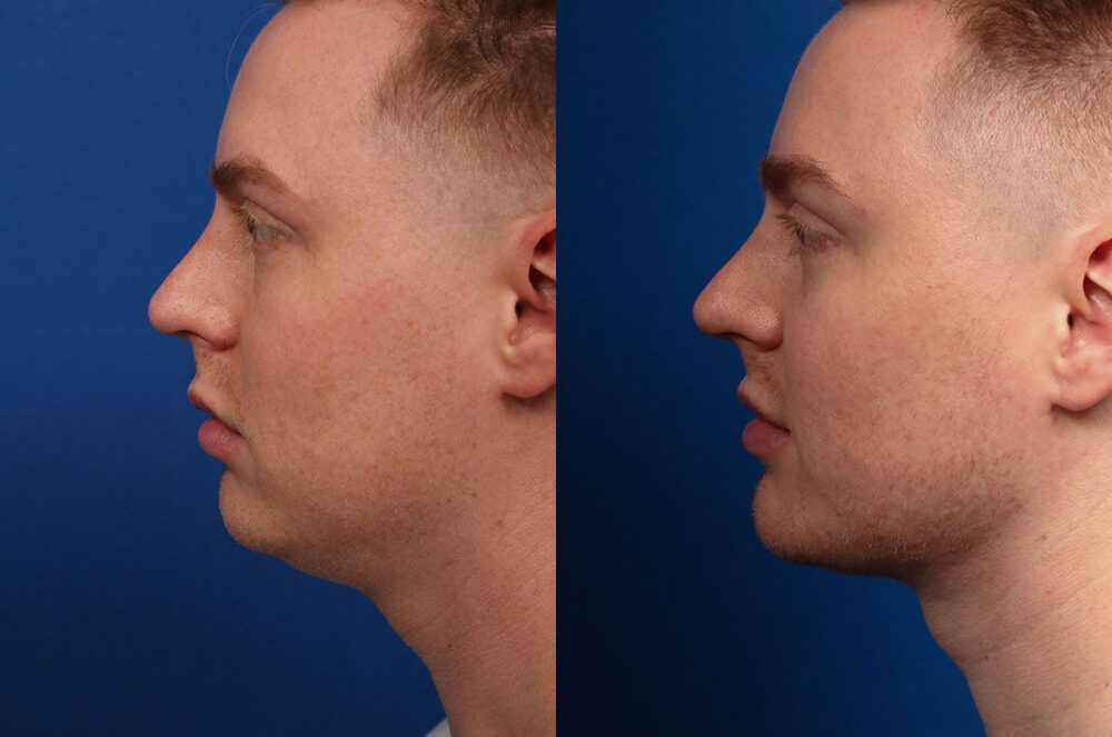 Neck Lift In Detroit & Troy, MI | Andrew Compton, MD
